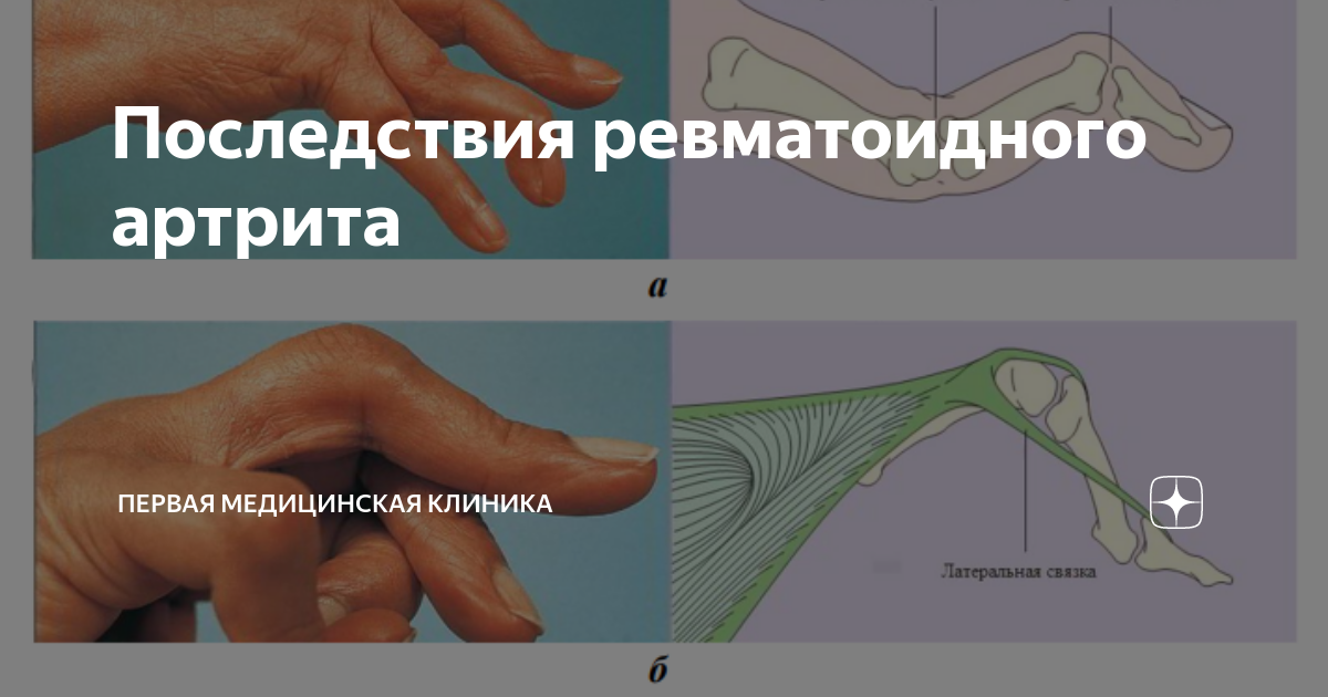 Последствия ревматоидного артрита Первая Медицинская Клиника Дзен