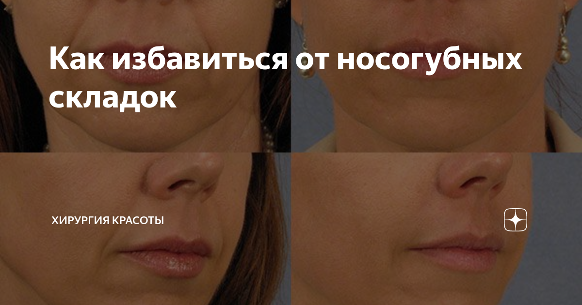 Как избавиться от носогубных складок Хирургия красоты Дзен