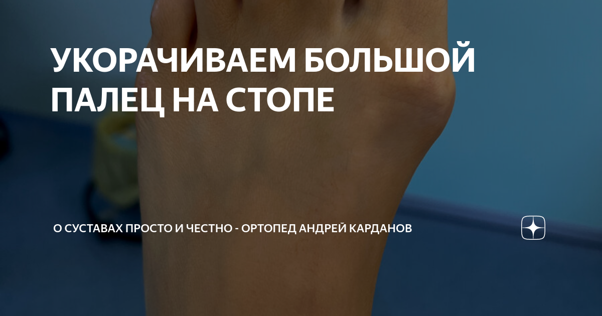 УКОРАЧИВАЕМ БОЛЬШОЙ ПАЛЕЦ НА СТОПЕ | О СУСТАВАХ ПРОСТО И ЧЕСТНО ...