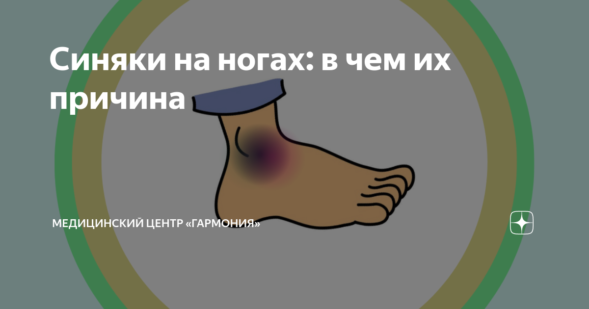 Синяки на ногах: в чем их причина | Медицинский центр «Гармония» | Дзен