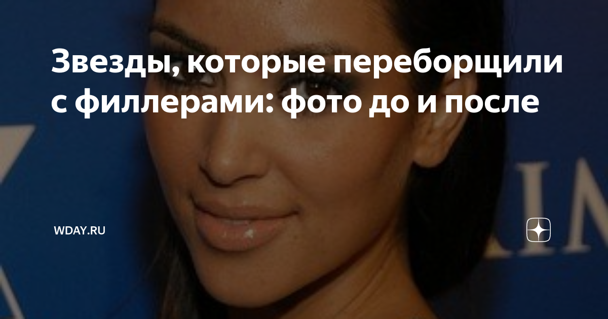Звезды, которые переборщили с филлерами: фото до и после | Wday.ru | Дзен