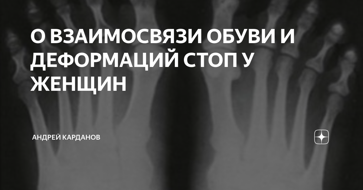 О ВЗАИМОСВЯЗИ ОБУВИ И ДЕФОРМАЦИЙ СТОП У ЖЕНЩИН | О СУСТАВАХ ПРОСТО И ...