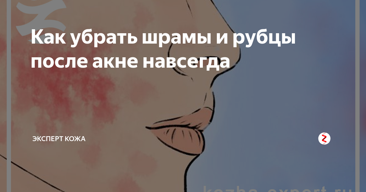 Как убрать шрамы и рубцы после акне навсегда Эксперт кожа Дзен