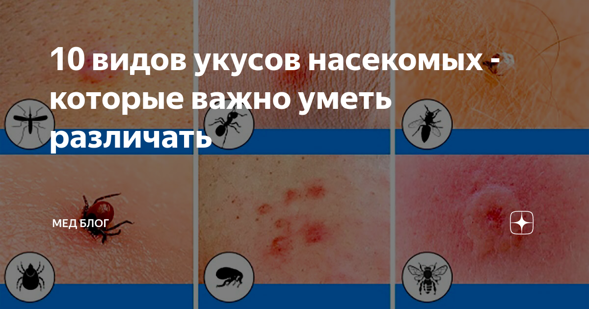 10 видов укусов насекомых - которые важно уметь различать | Мед Блог | Дзен