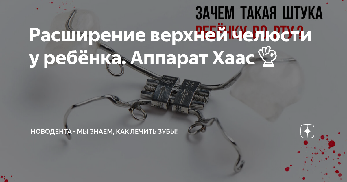 Расширение верхней челюсти у ребёнка. Аппарат Хаас👌 | НОВОДЕНТА - Мы ...