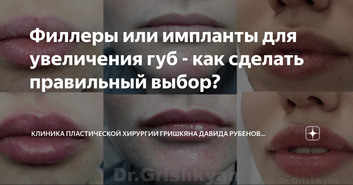 Филлеры или импланты для увеличения губ - как сделать правильный выбор ...