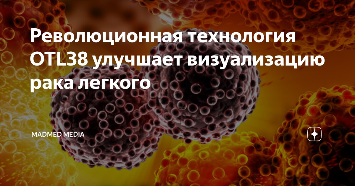 Революционная технология OTL38 улучшает визуализацию рака легкого ...