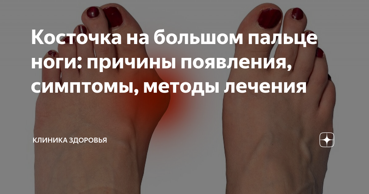 Косточка на большом пальце ноги: причины появления, симптомы, методы ...