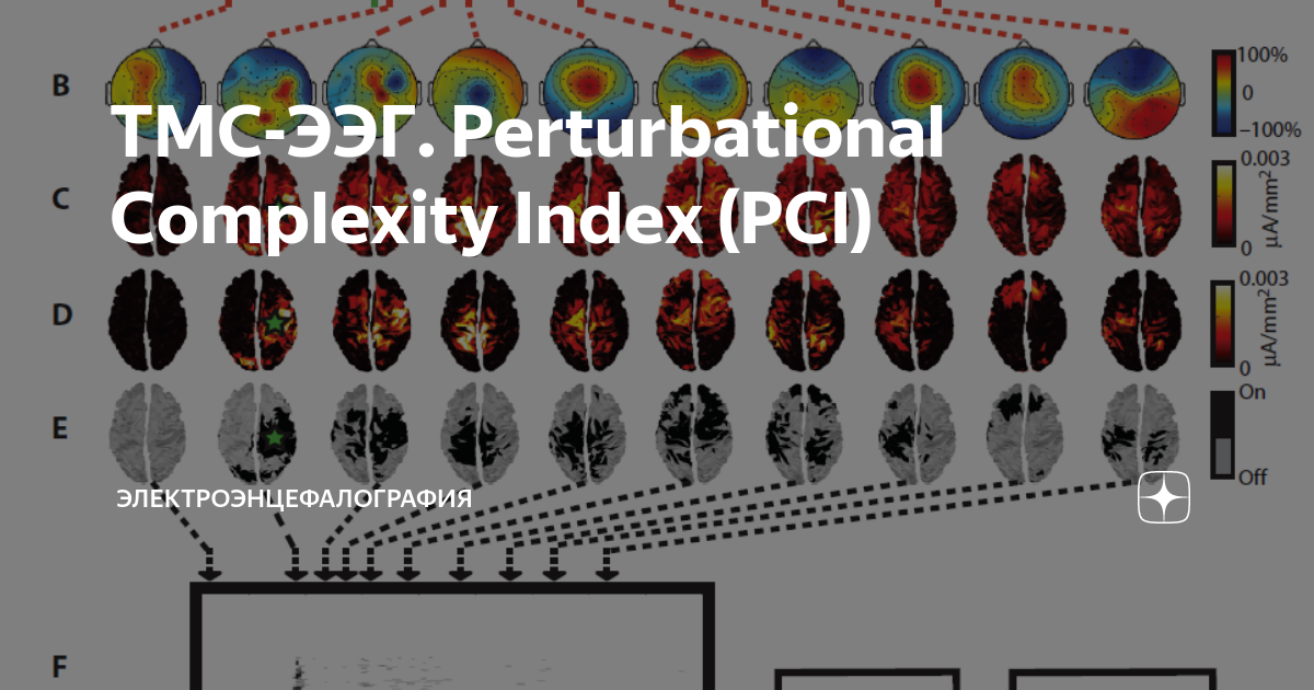 ТМС-ЭЭГ. Perturbational Complexity Index (PCI) | Электроэнцефалография ...