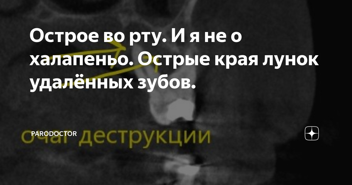 Острое во рту. И я не о халапеньо. Острые края лунок удалённых зубов ...