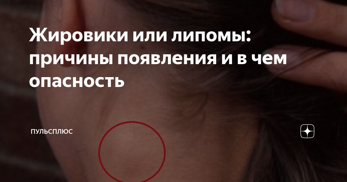 Жировики или липомы: причины появления и в чем опасность | ПульсПлюс | Дзен