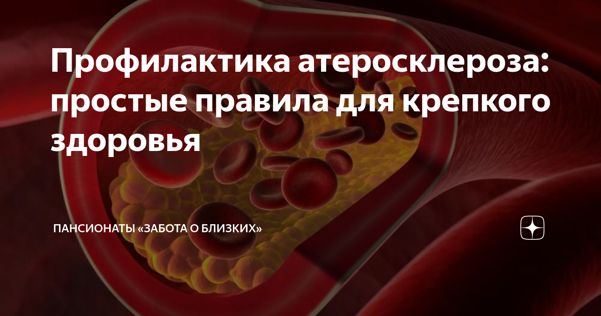 Профилактика атеросклероза: простые правила для крепкого здоровья ...