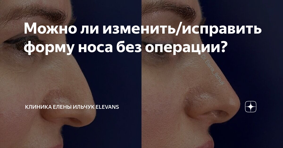 Можно ли изменить исправить форму носа без операции Клиника Елены Ильчук Elevans Дзен