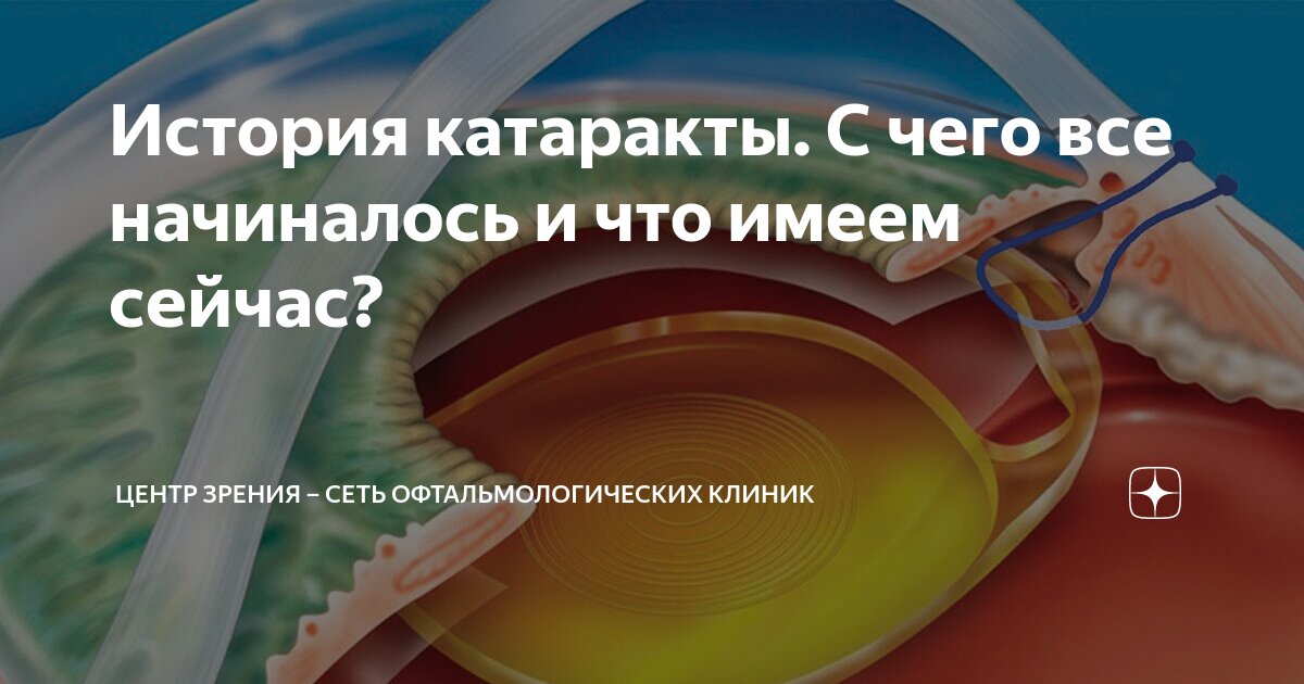 История катаракты. С чего все начиналось и что имеем сейчас? | Центр ...