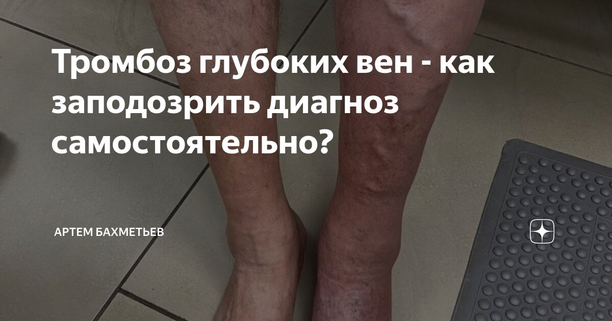 Тромбоз глубоких вен как заподозрить диагноз самостоятельно Блог