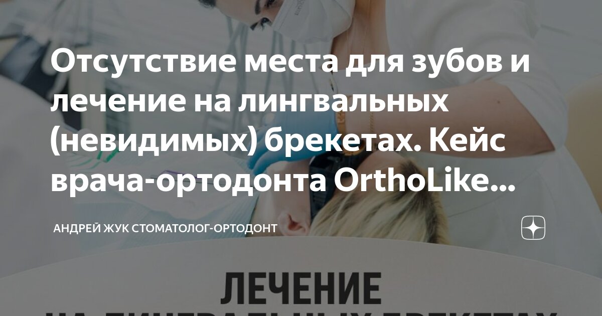 Отсутствие места для зубов и лечение на лингвальных (невидимых) брекетах. Кейс врача-ортодонта ...