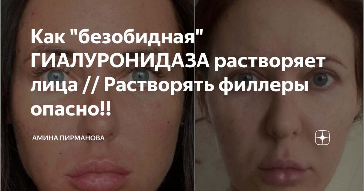 Как "безобидная" ГИАЛУРОНИДАЗА растворяет лица // Растворять филлеры ...