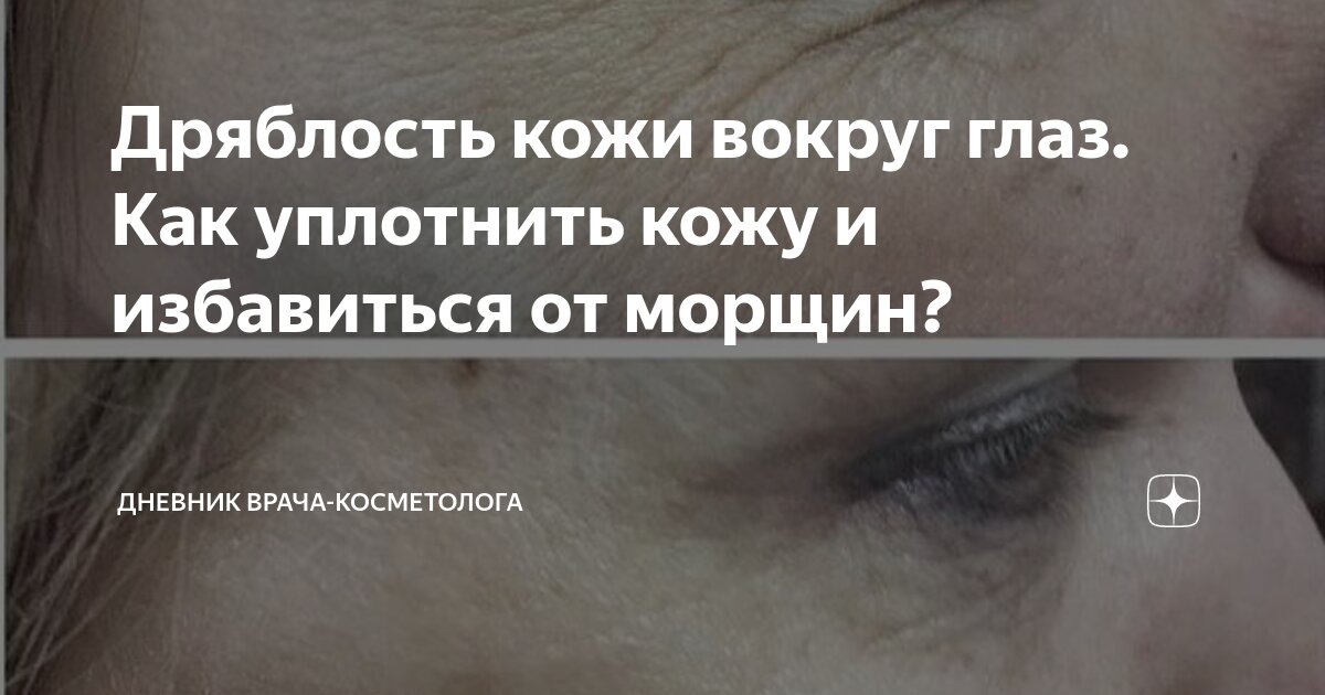 Дряблость кожи вокруг глаз. Как уплотнить кожу и избавиться от морщин ...