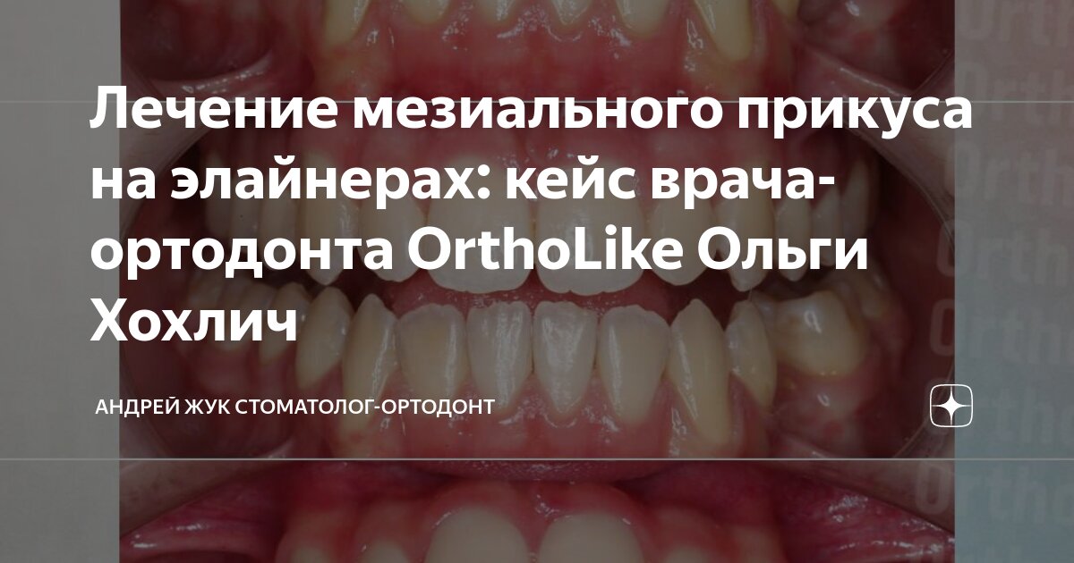 Лечение мезиального прикуса на элайнерах: кейс врача-ортодонта OrthoLike Ольги Хохлич | Андрей ...