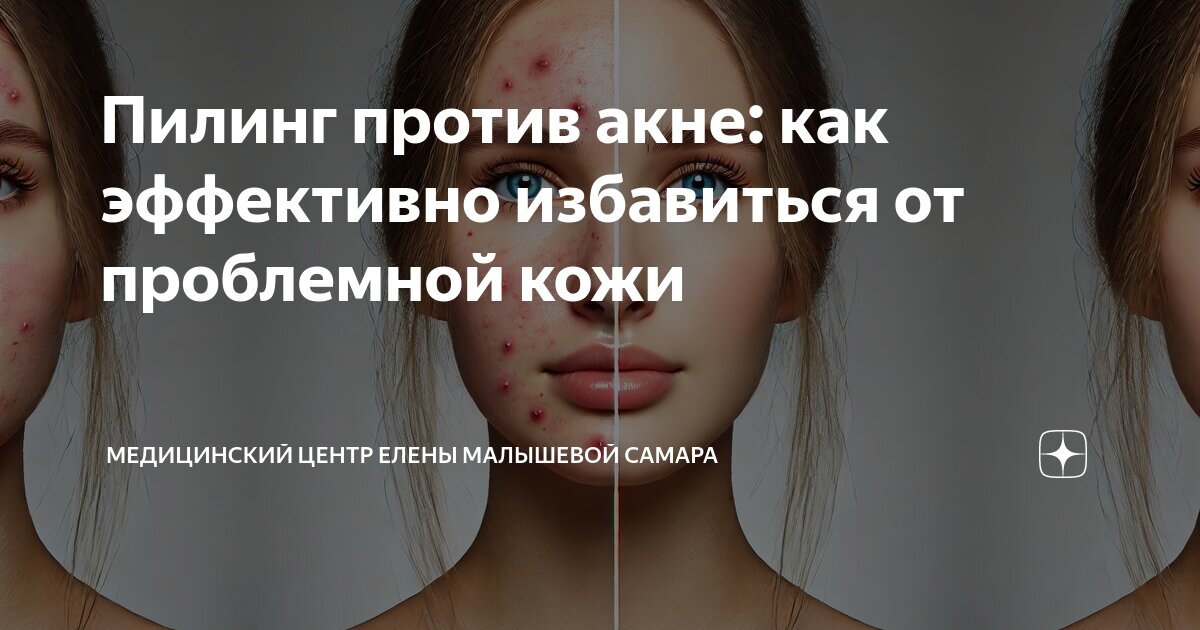 Пилинг против акне: как эффективно избавиться от проблемной кожи ...