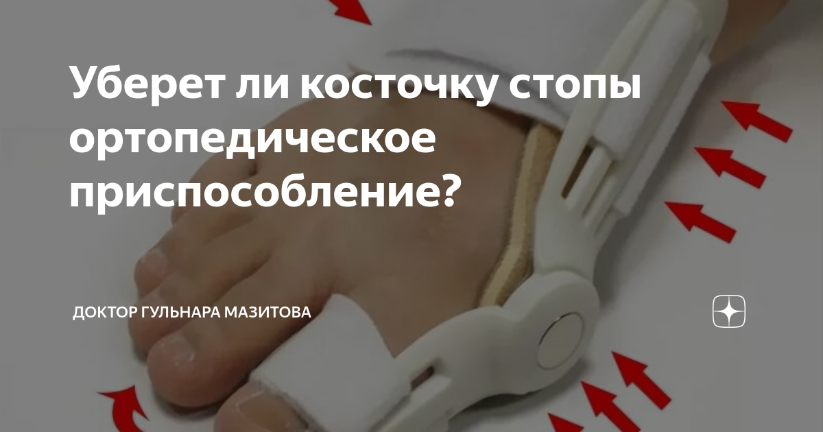 Уберет ли косточку стопы ортопедическое приспособление? | Доктор ...
