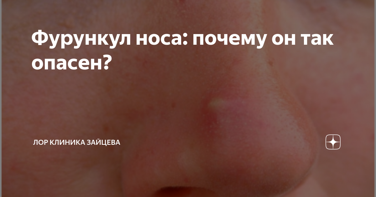 Фурункул носа: почему он так опасен? | ЛОР КЛИНИКА ЗАЙЦЕВА | Дзен