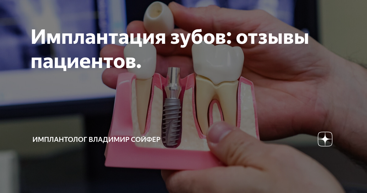 Имплантация зубов: отзывы пациентов. | Хирургия - Владимир Сойфер | Дзен