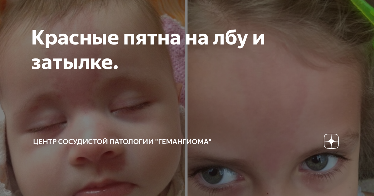 Красные пятна на лбу и затылке Центр сосудистой патологии