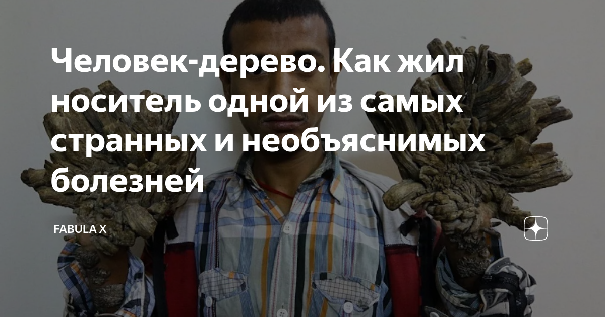 Человек-дерево. Как жил носитель одной из самых странных и необъяснимых ...