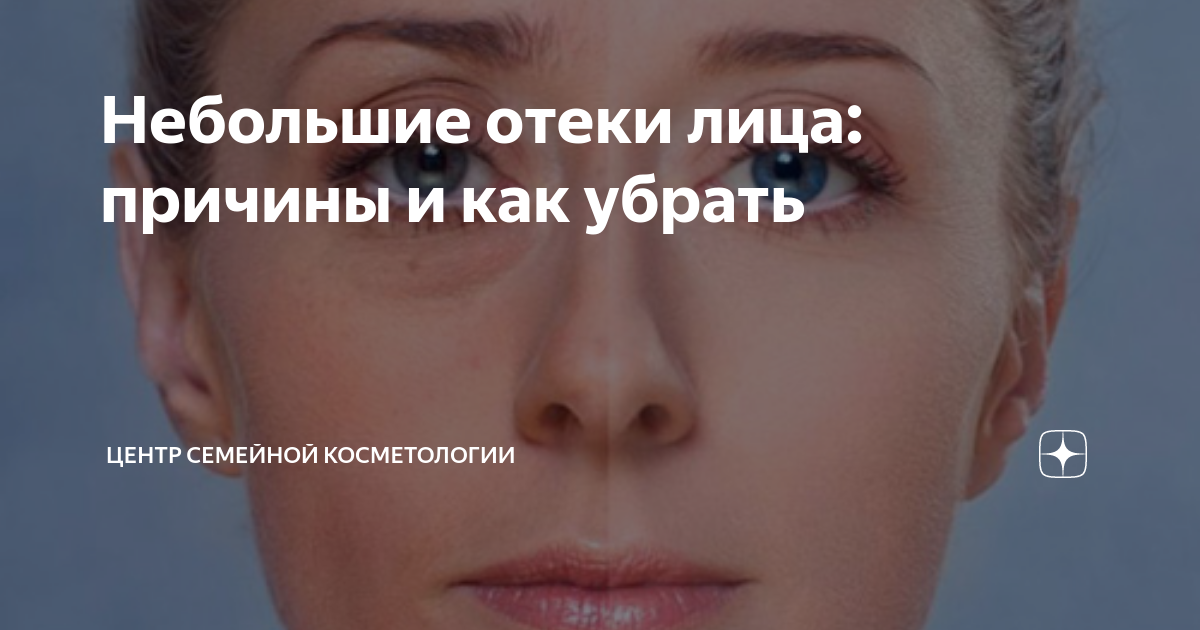 Небольшие отеки лица: причины и как убрать | Центр семейной ...