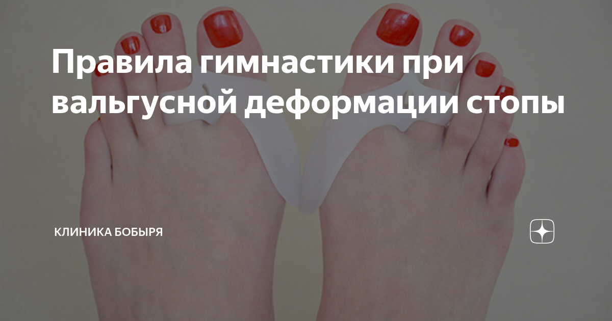 Правила гимнастики при вальгусной деформации стопы | Клиника Бобыря | Дзен