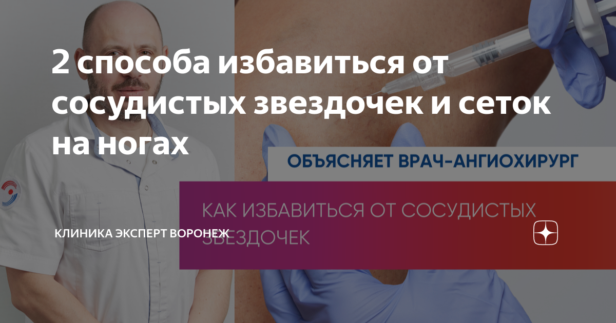2 способа избавиться от сосудистых звездочек и сеток на ногах | Клиника ...