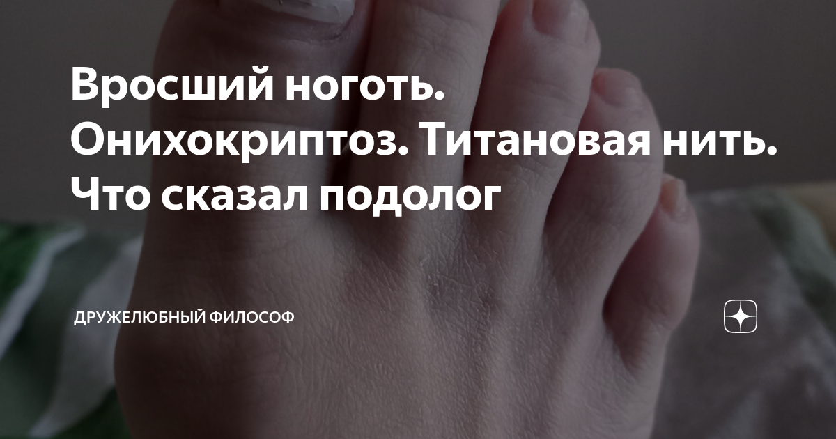 Вросший ноготь. Онихокриптоз. Титановая нить. Что сказал подолог ...