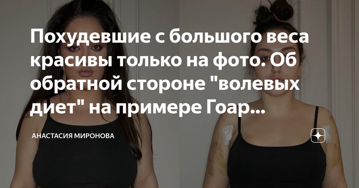 Похудевшие с большого веса красивы только на фото. Об обратной стороне ...