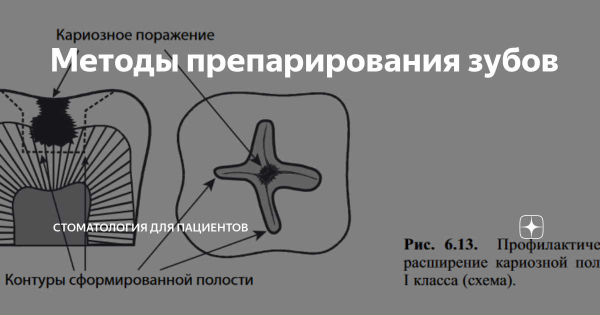 Методы препарирования зубов | Стоматология для пациентов | Дзен