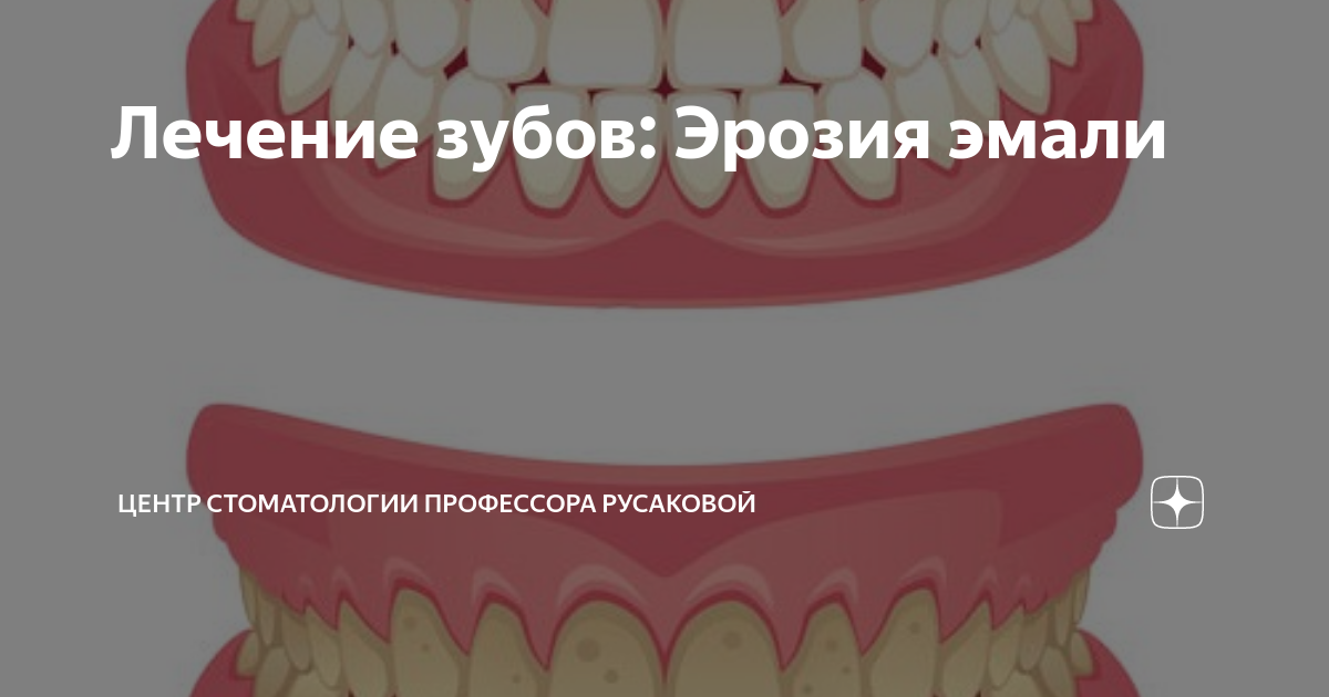 Лечение зубов: Эрозия эмали | Центр стоматологии Профессора Русаковой ...