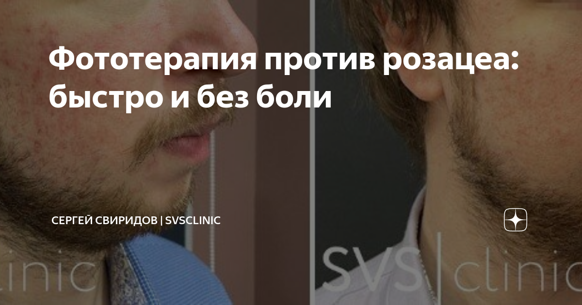 Фототерапия против розацеа: быстро и без боли | Сергей Свиридов ...