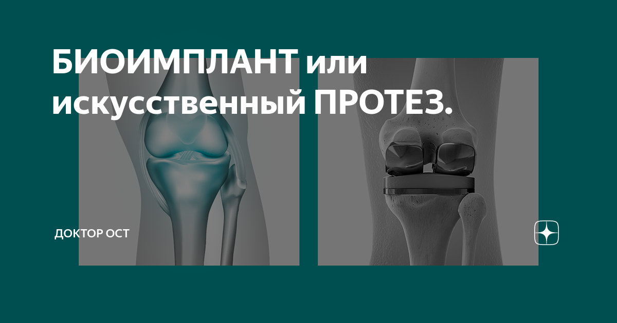 БИОИМПЛАНТ или искусственный ПРОТЕЗ. | Доктор ОСТ | Центр лечения ...