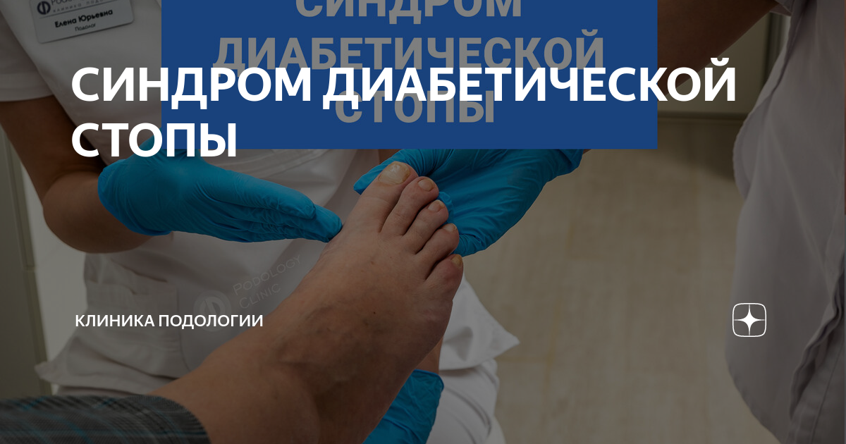 СИНДРОМ ДИАБЕТИЧЕСКОЙ СТОПЫ | КЛИНИКА ПОДОЛОГИИ ПОЛЁТ | Дзен