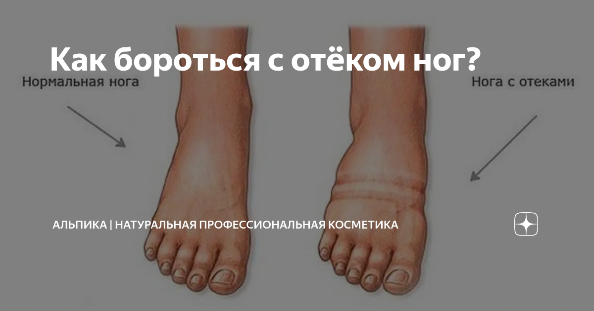 Как бороться с отёком ног Альпика Натуральная профессиональная