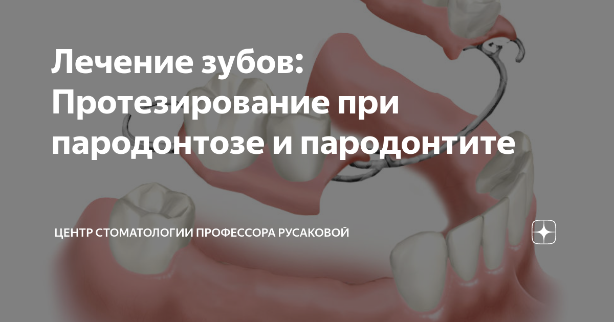 Лечение зубов: Протезирование при пародонтозе и пародонтите | Центр ...