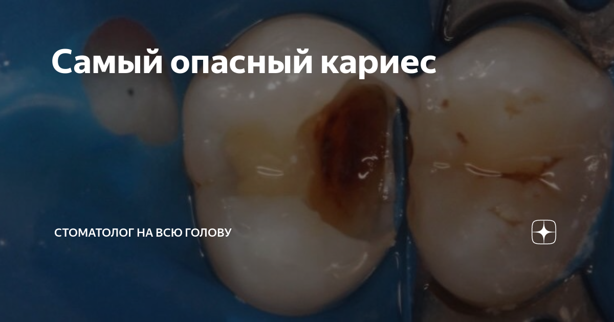 Самый опасный кариес | Стоматолог на всю голову | Дзен