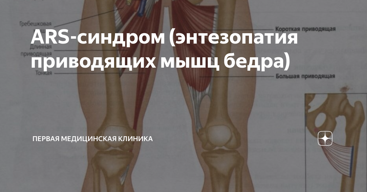 ARS-синдром (энтезопатия приводящих мышц бедра) | Первая Медицинская Клиника | Дзен