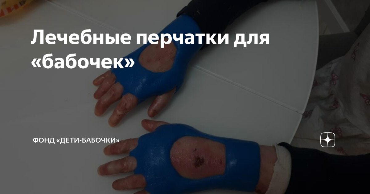 Лечебные перчатки для «бабочек» | Фонд «Дети-бабочки» | Дзен