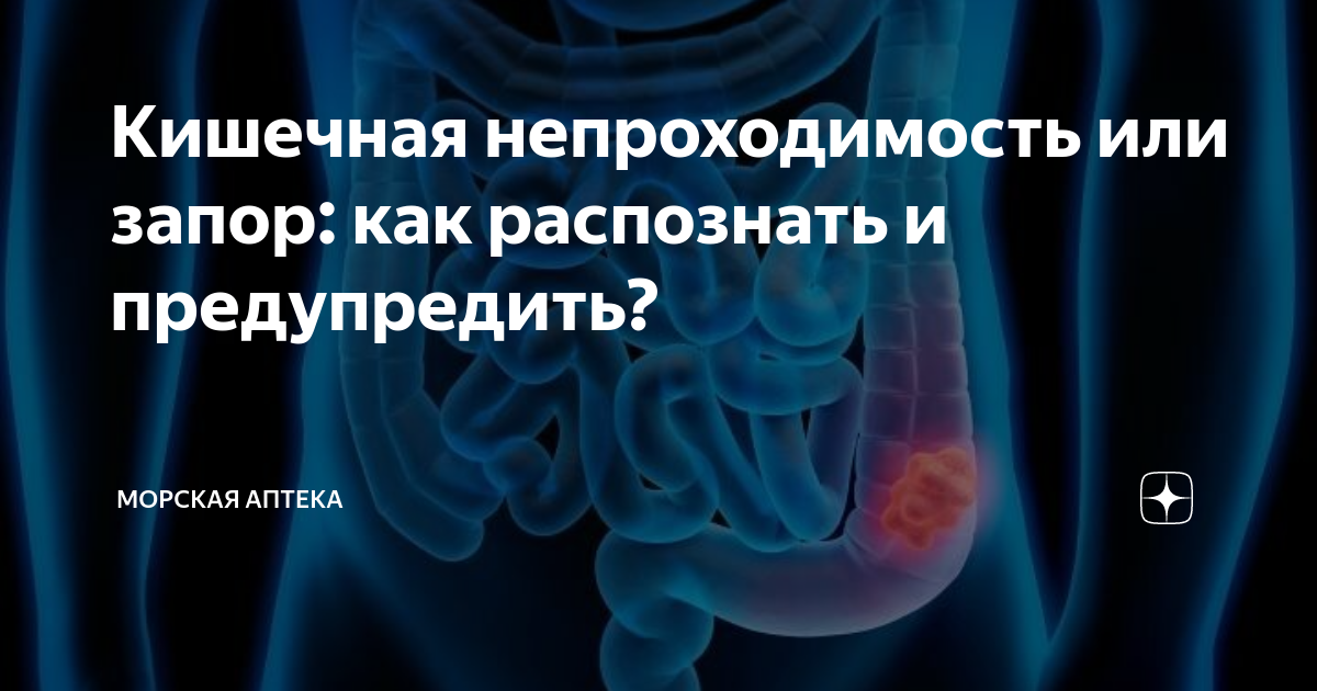 Кишечная непроходимость или запор: как распознать и предупредить ...