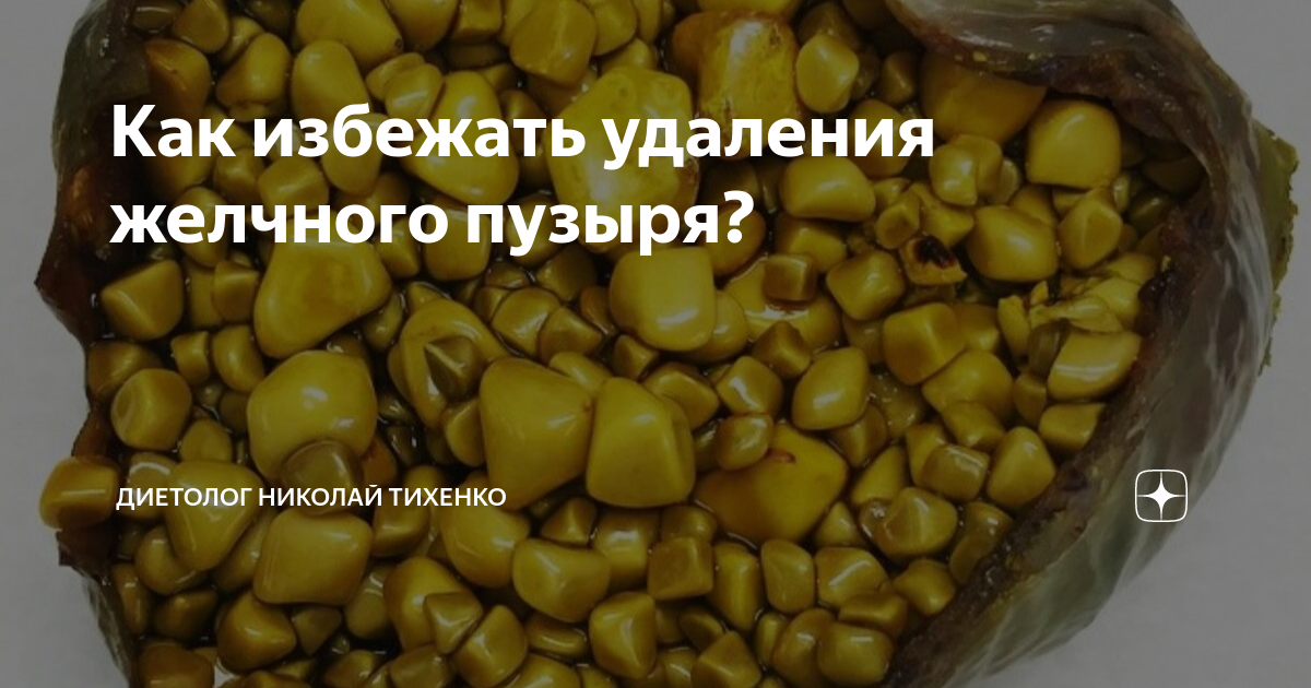 Как избежать удаления желчного пузыря Диетолог Николай Тихенко Дзен