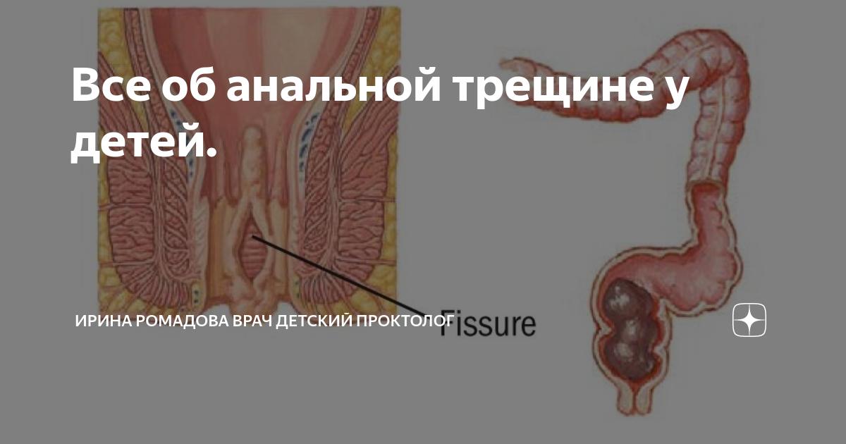 Все об анальной трещине у детей. | Ирина Ромадова врач детский ...