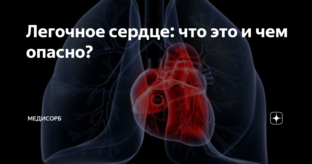 Легочное сердце: что это и чем опасно? | Медисорб | Дзен