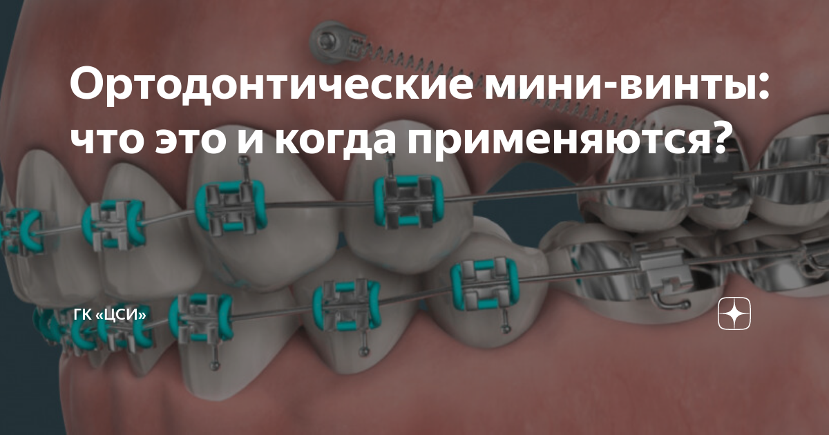 Ортодонтические мини-винты: что это и когда применяются? | ГК «ЦСИ» | Дзен