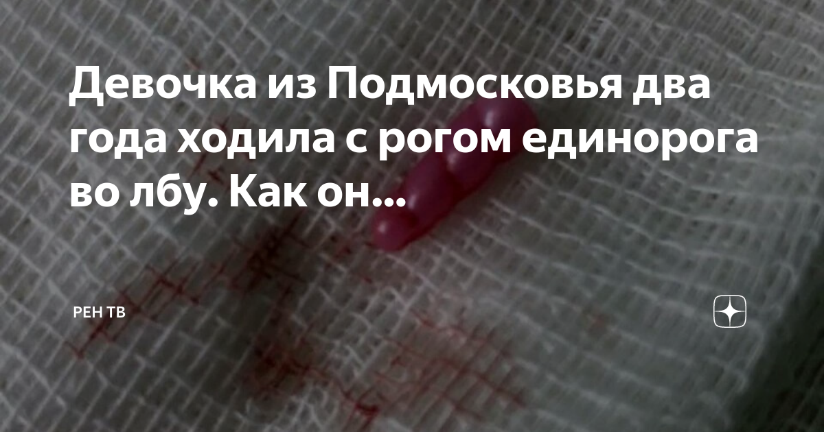 Девочка из Подмосковья два года ходила с рогом единорога во лбу. Как он ...